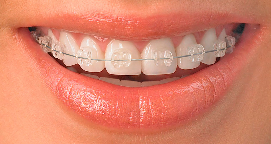 Qué tener en cuenta antes de iniciar un tratamiento de ortodoncia ...